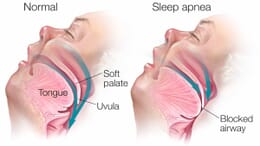 What Are The Main Causes Of Sleep Apnea Sleep Care Online